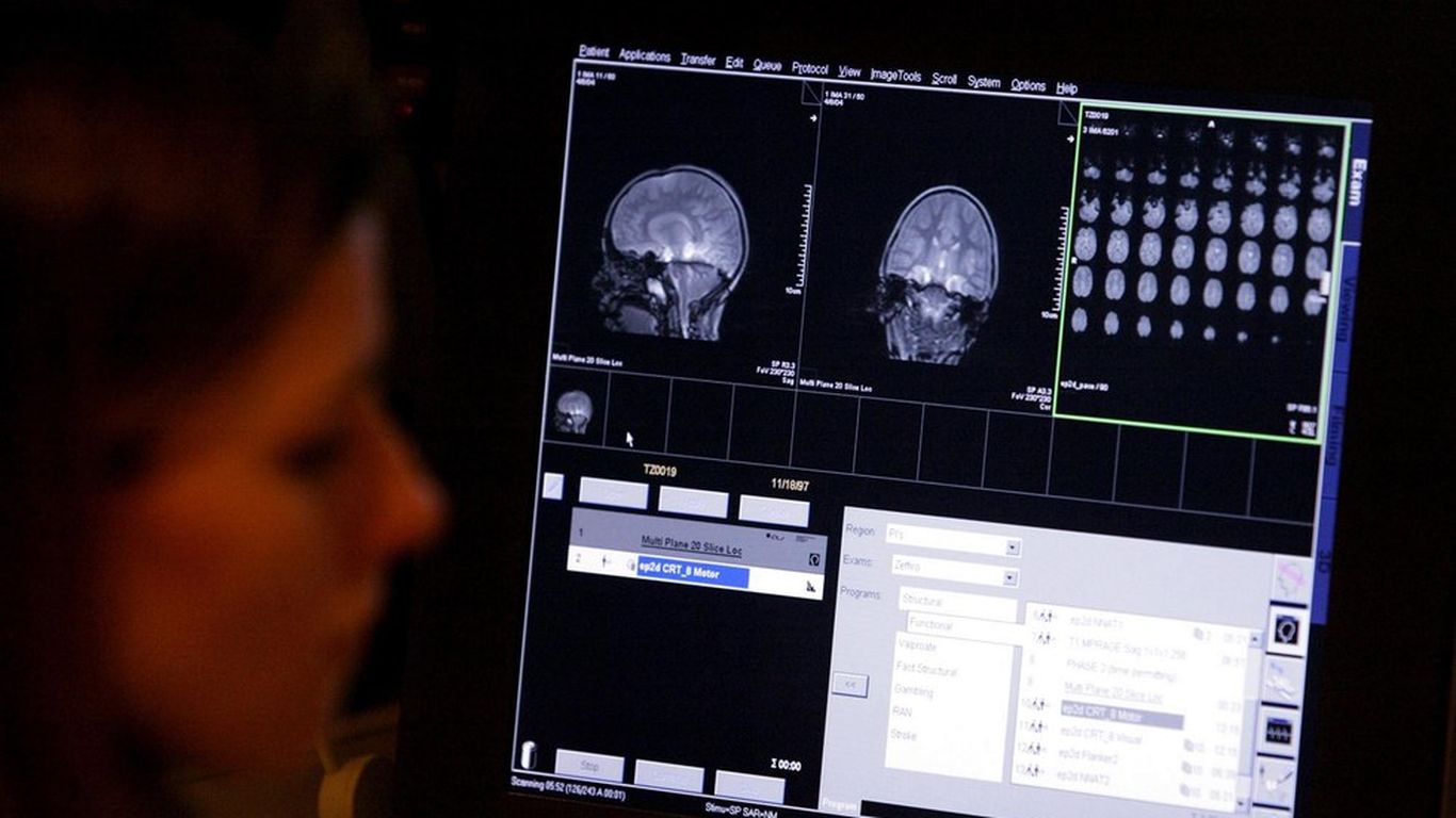 Brain scans help to identify autism in infants