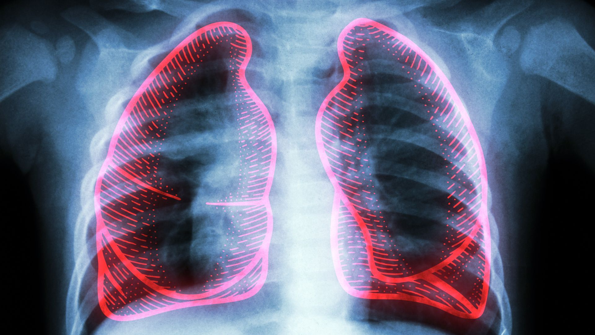 Walking pneumonia cases rise in Dallas-Fort Worth - Axios Dallas