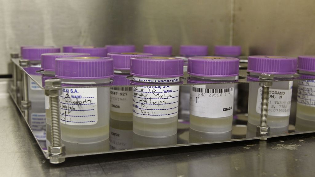 New non-invasive test speeds tuberculosis diagnosis