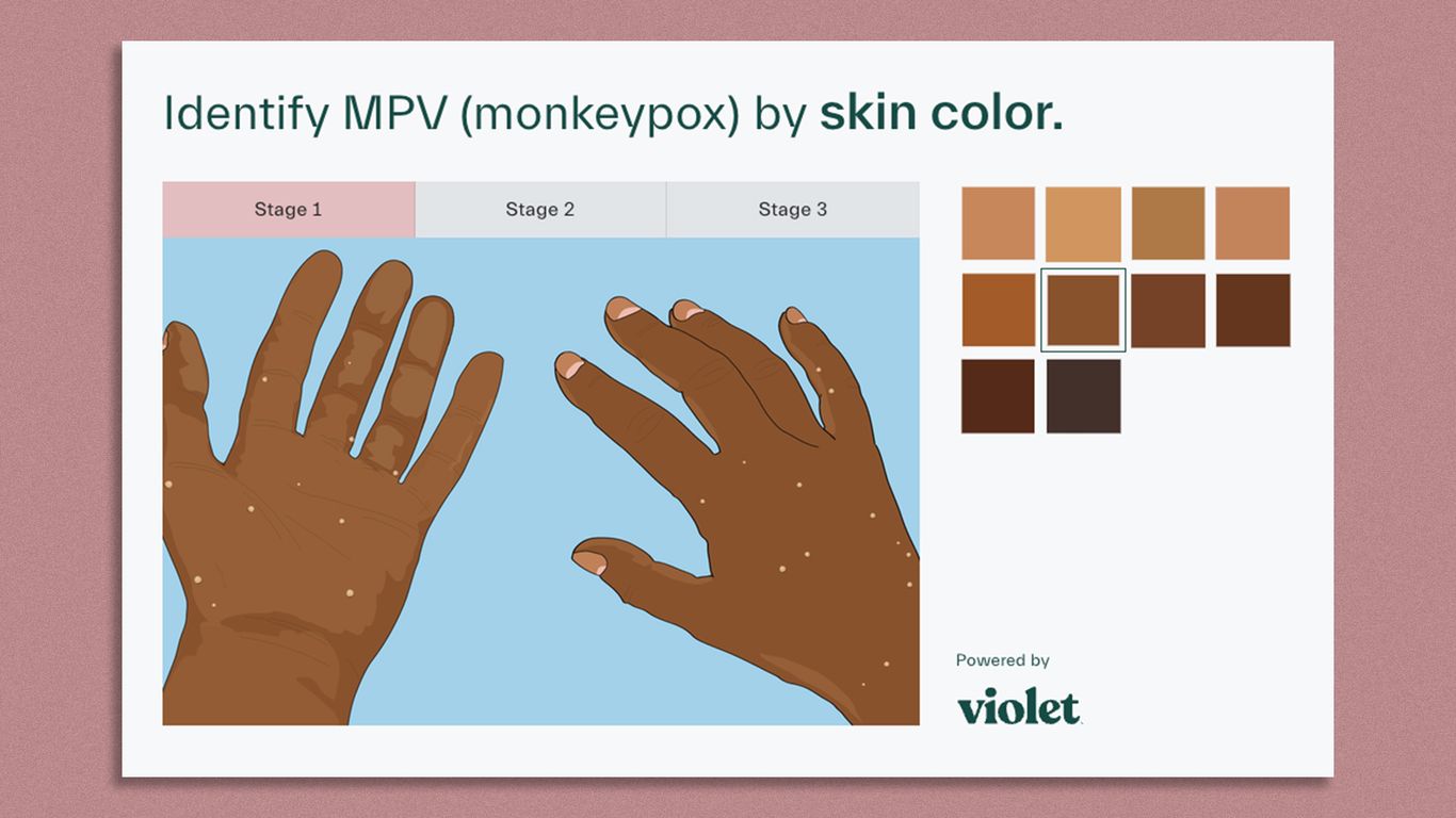 Startups' tool helps doctors identify monkeypox on dark skin