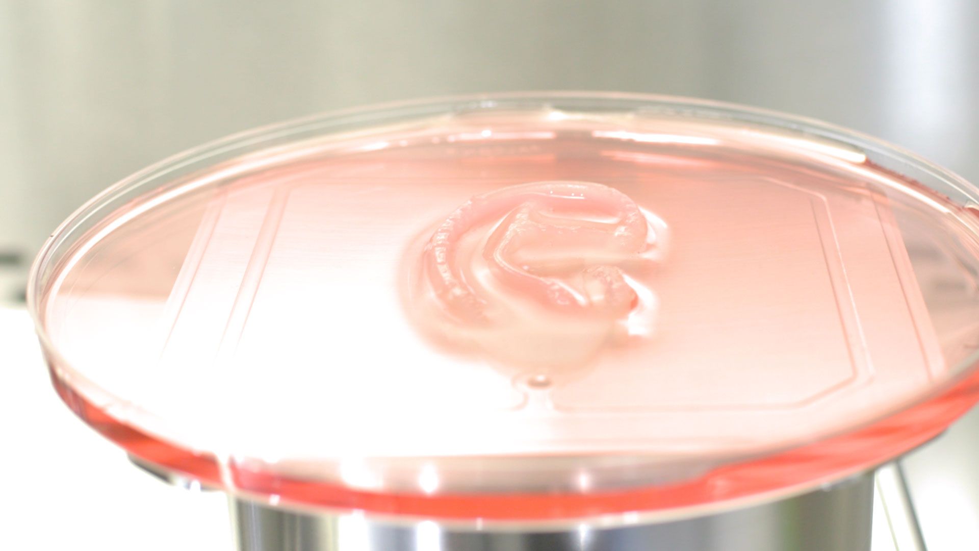 3D ear printed with human cells implanted in woman with microtia